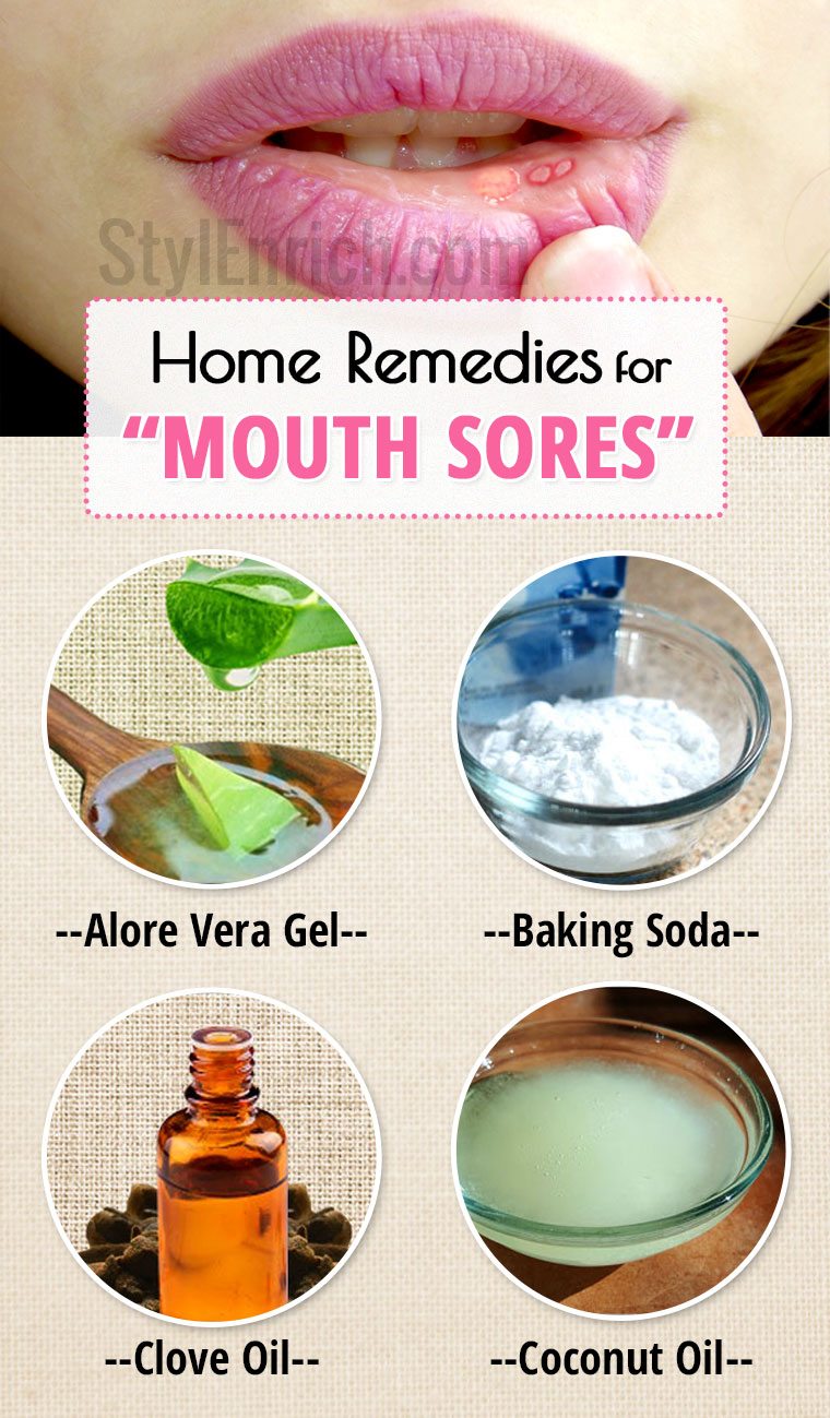 Home Remedies For Mouth Sores Or Canker Sores