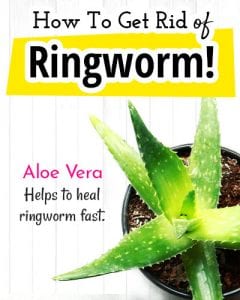 How to Get Rid of Ringworm? - Home Remedies for Ringworm